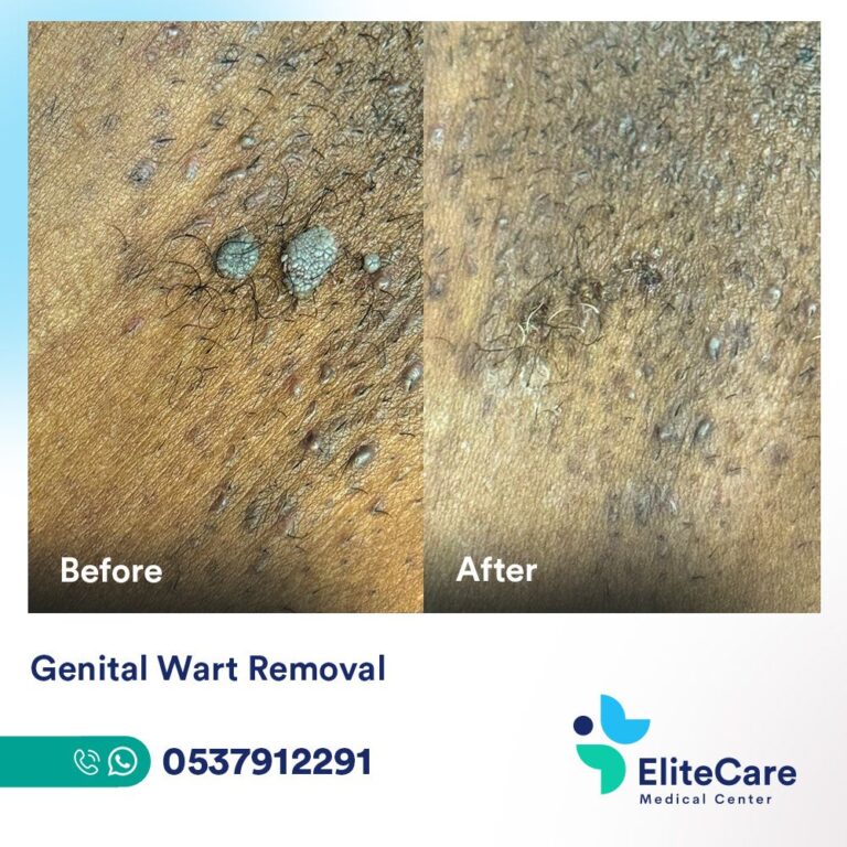 Genital Warts Treatment in Accra, Ghana - Elitecare Center